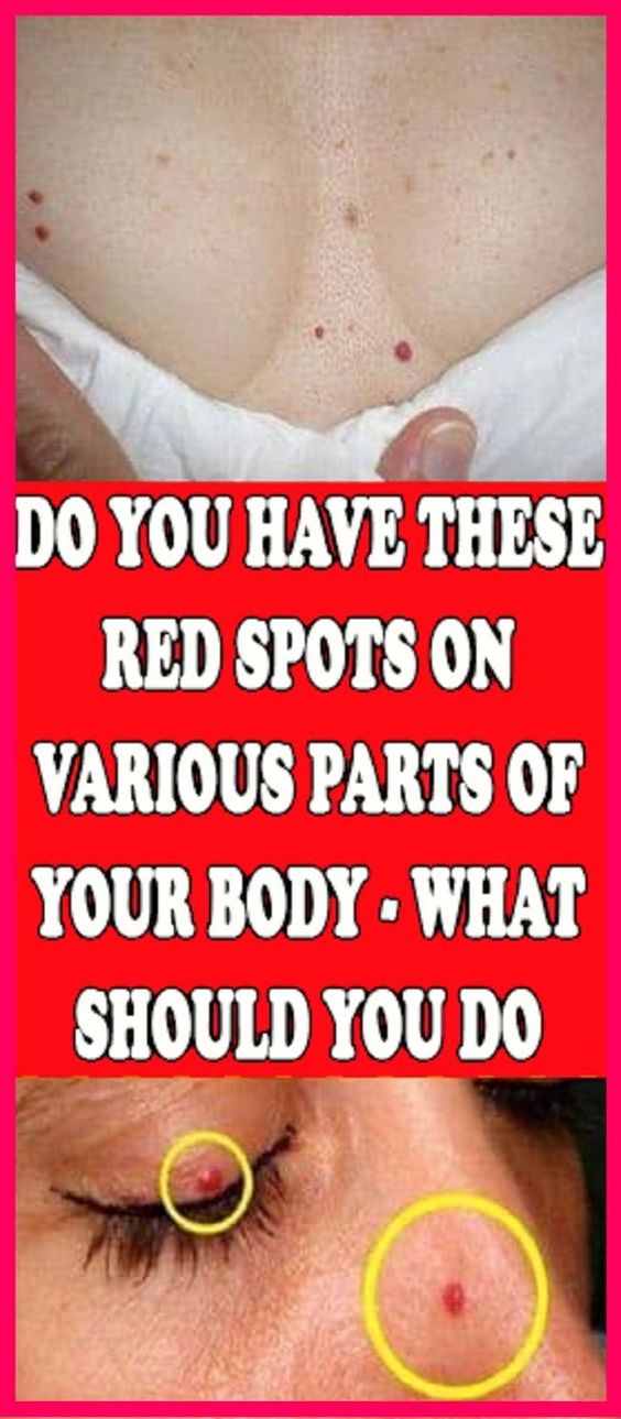 Do You Have These Red Spots On Various Parts Of Your Body!!! – Natural ...