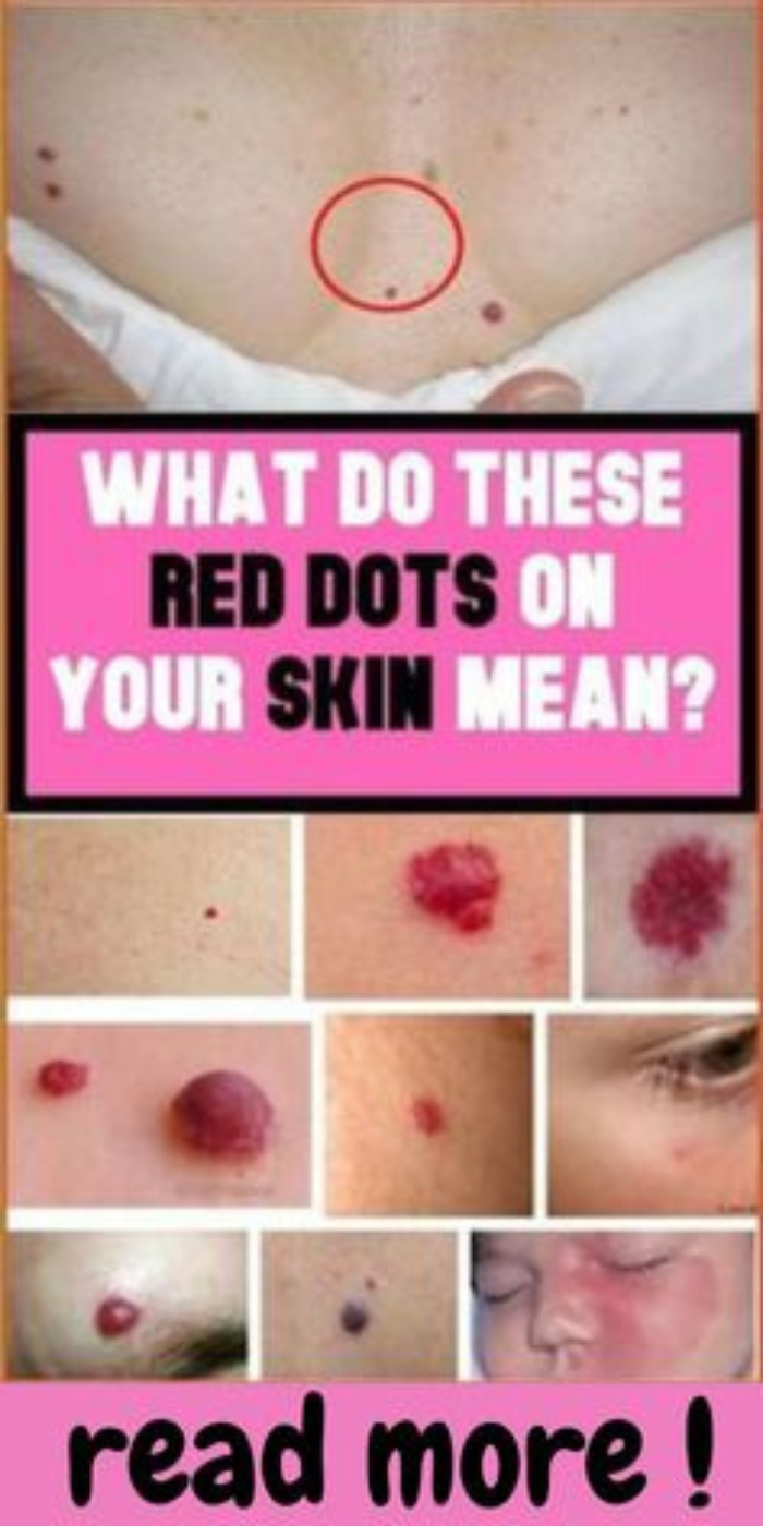 What Do These Red Dots On Your Skin Mean Natural Health Care