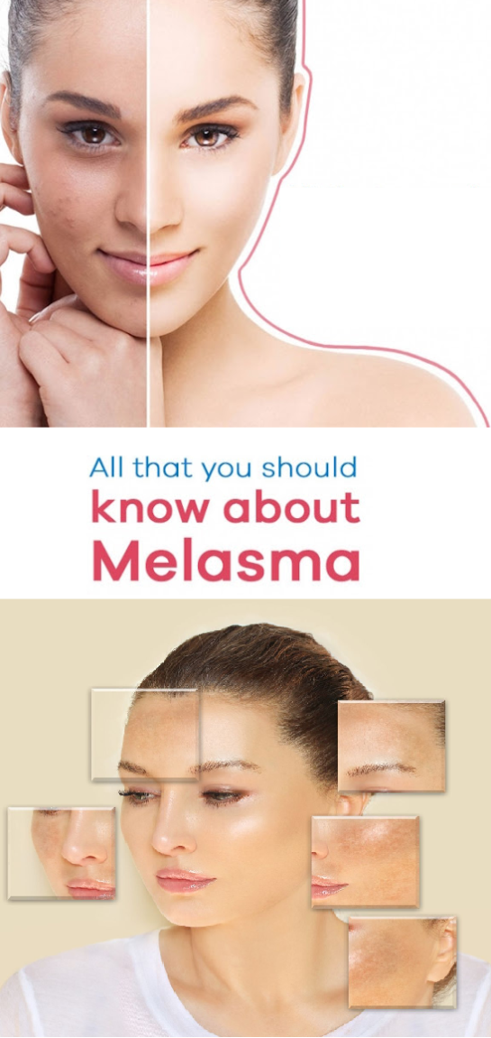Understanding Melasma: Its Causes, Symptoms, and Recommended Treatments ...