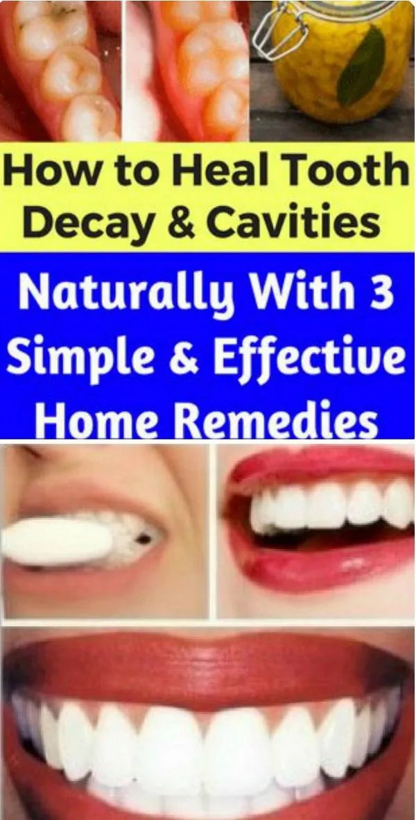 How to Heal Cavities and Tooth Decay Naturally with These Home Remedies ...