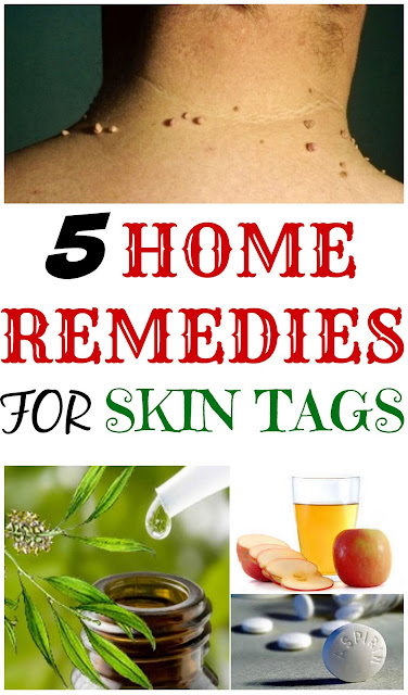 Top 5 Home Remedies To Remove Skin Tags + VIDEO – Natural Health Care